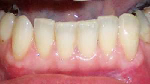 Deckung zweier Rezessionen an unteren Eckzähnen mit ...